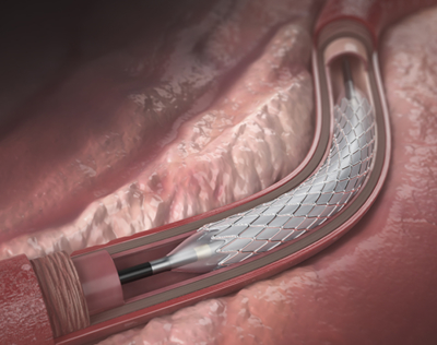 Custom design peripheral vascular applications – PTFE Covered stents ...